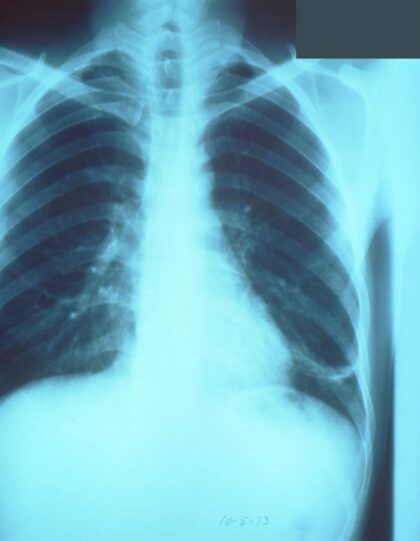 Local Pediatric Pneumonia Cases Surge as Mycoplasma Infections Rise ...
